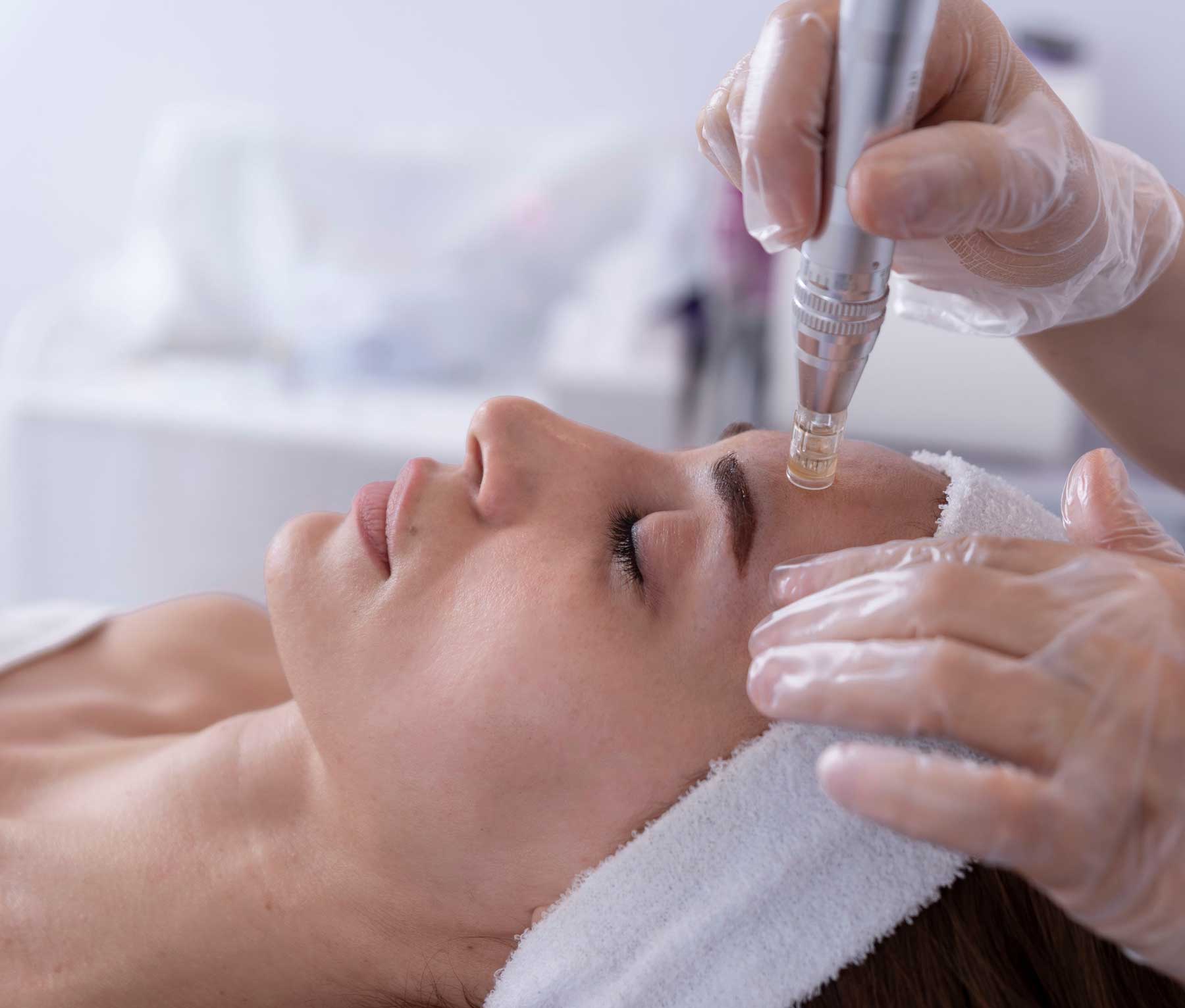 Skin Needling – Collagen Induction Therapy - SoloTu